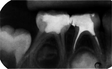 Pulpectomy and Root Canal Treatment (RCT) in Primary Teeth: Techniques ...