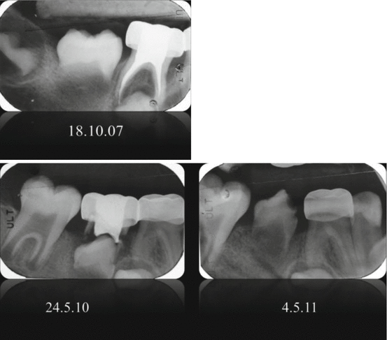 Pulpectomy and Root Canal Treatment (RCT) in Primary Teeth: Techniques ...