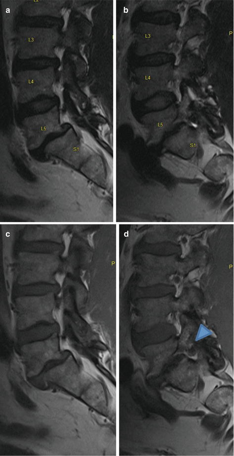 Medical Imaging of the Lumbar Facet Joint | SpringerLink