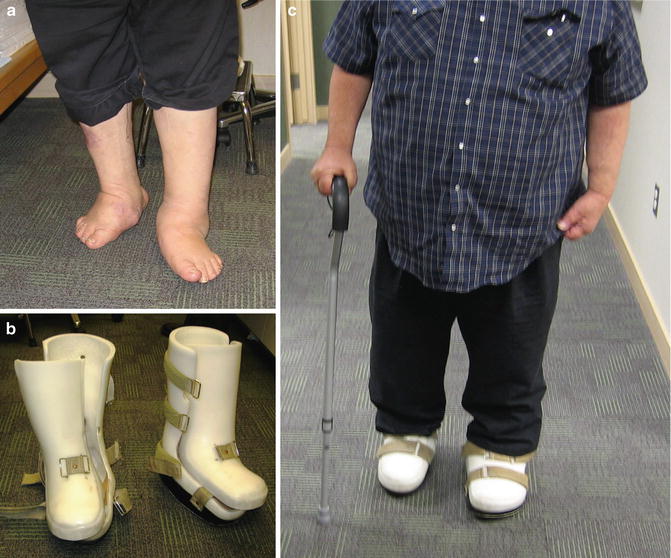 Management of the Charcot Ankle | SpringerLink