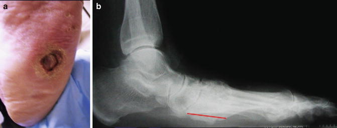 Exostectomy for Charcot Arthropathy | SpringerLink