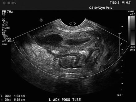 Pelvic Inflammatory Disease and Tubo-Ovarian Abscesses | SpringerLink