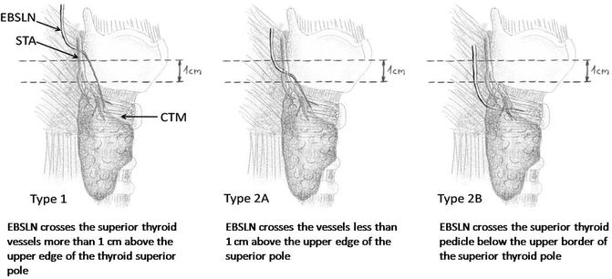 External Branch of Superior Laryngeal Nerve (EBSLN) Anatomic ...