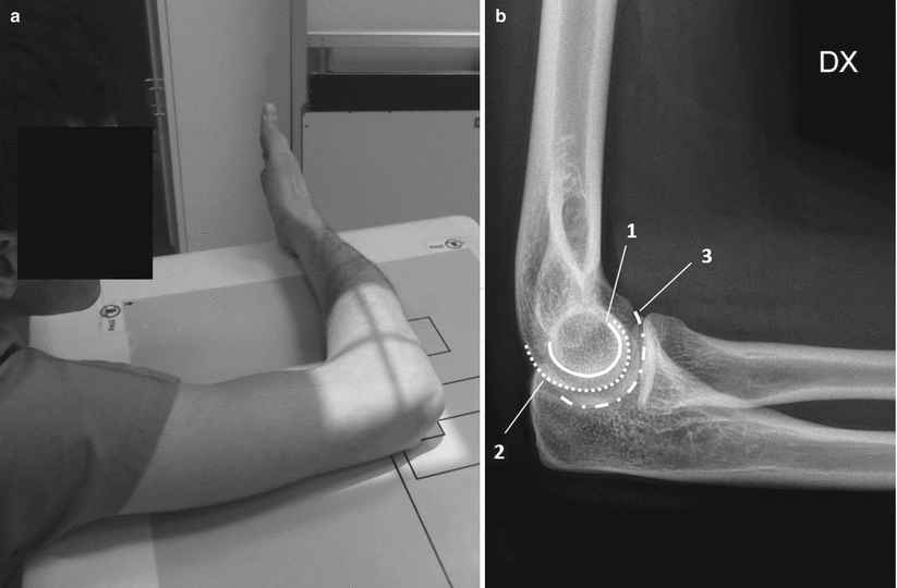 Approach to the Radiological Imaging of the Elbow | SpringerLink