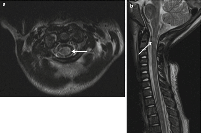 SCIWORA | SpringerLink