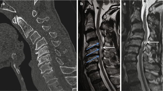 SCIWORA | SpringerLink