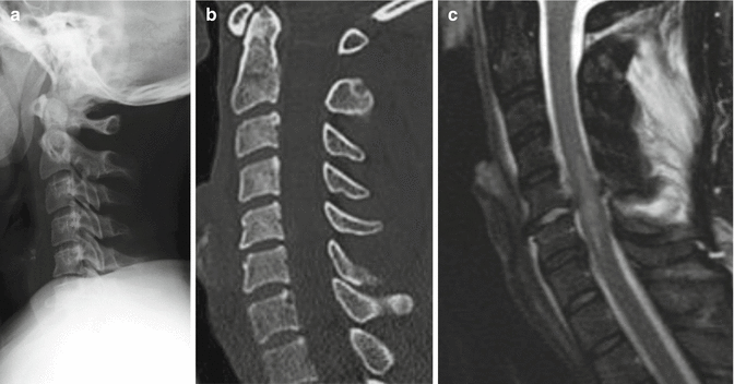SCIWORA | SpringerLink