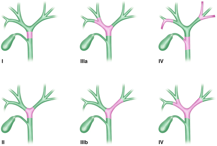 Point-of-Care Clinical Guide: Cholangiocarcinoma | SpringerLink