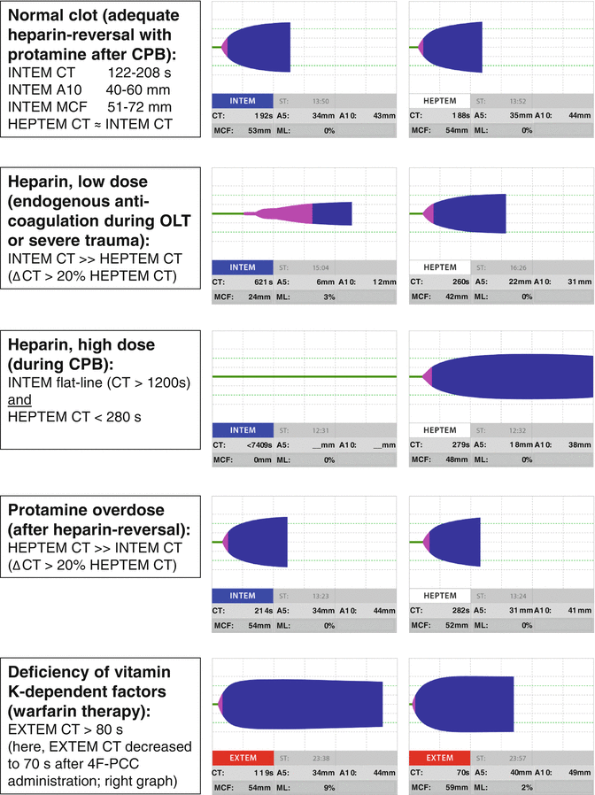 Rotational Thromboelastometry (ROTEM®) | SpringerLink