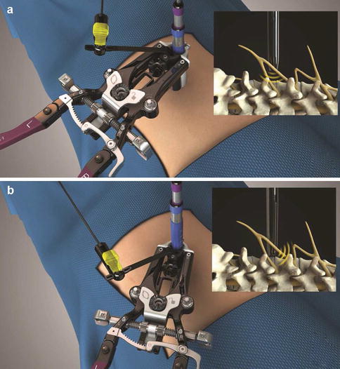 Lateral Transpsoas Retractor Technology | SpringerLink