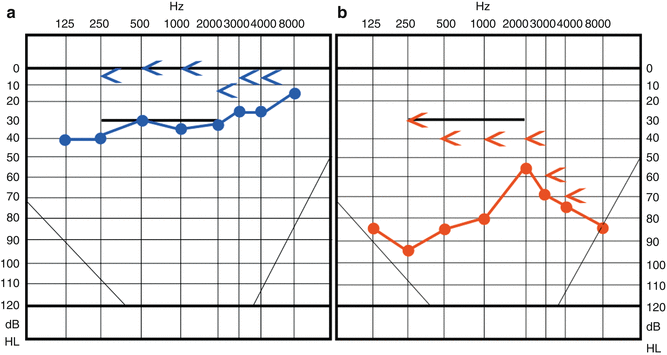 Preoperative Diagnosis of Otosclerosis | SpringerLink