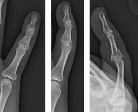 Operative Treatment of Volar PIP Joint Fracture-Dislocations | SpringerLink