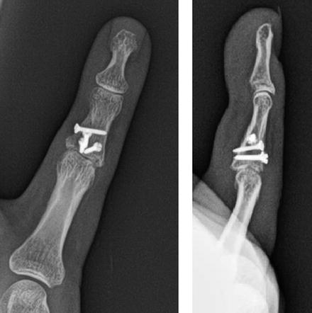 Operative Treatment of Volar PIP Joint Fracture-Dislocations | SpringerLink