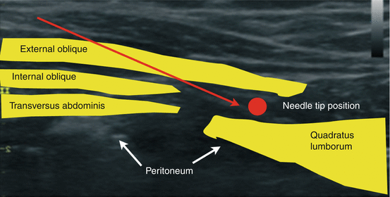Transverse Abdominis Plane Block: Evolution and Current Understanding ...