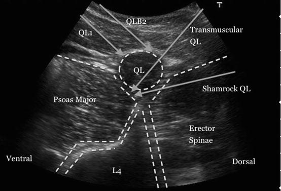 Transverse Abdominis Plane Block: Evolution and Current Understanding ...