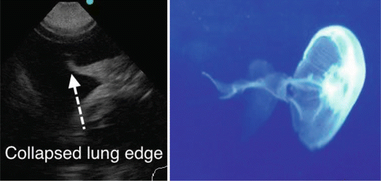 Lung Ultrasound in Anaesthesia and Critical Care Medicine | SpringerLink