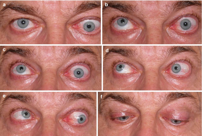 The Ocular Characteristics and Differential Diagnostics of Mixed Types ...