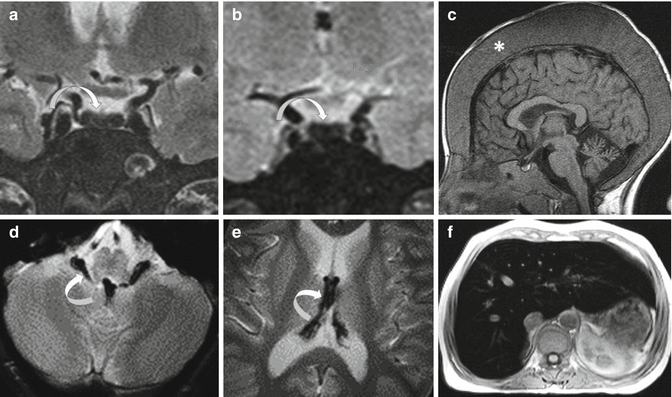 Pituitary Hemochromatosis | SpringerLink
