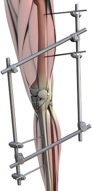 Damage Control Orthopaedics in the Low Resource Environment | SpringerLink