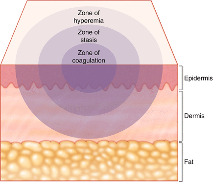 Burn Pathophysiology | SpringerLink