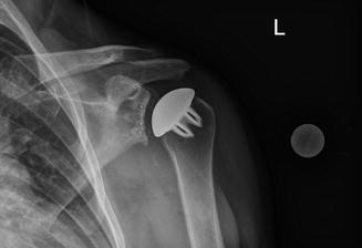 Stemless Humeral Head Replacement | SpringerLink