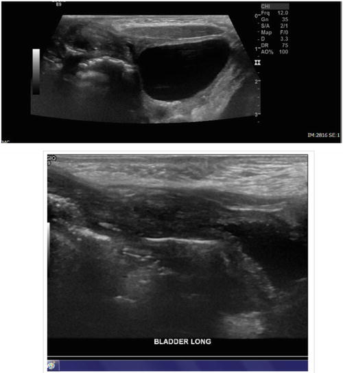 Congenital Anomalies of the Urinary Bladder | SpringerLink