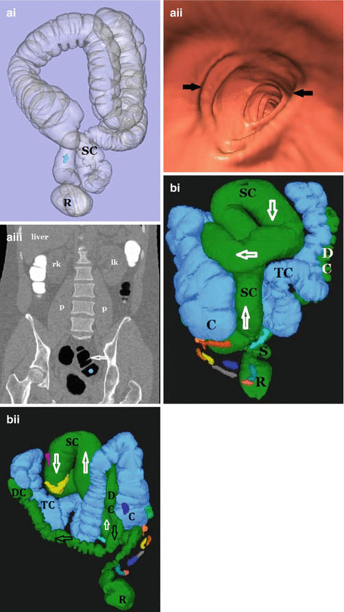 Anatomy of the Colon | SpringerLink