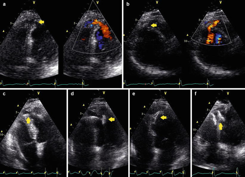 Percutaneous Ventricular Septal Defect Closure | SpringerLink