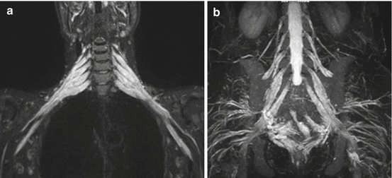 Magnetic Resonance Imaging of the Peripheral Nerve | SpringerLink
