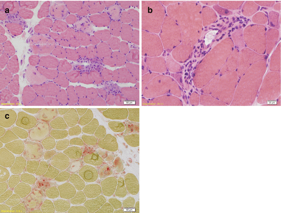 Necrotizing Autoimmune Myopathy | SpringerLink
