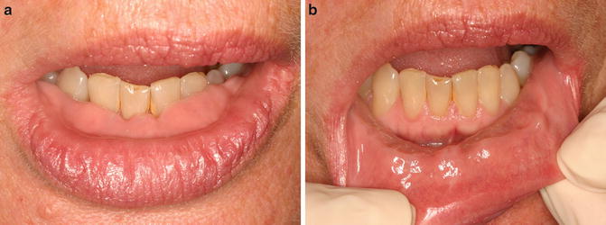 White Lesions | SpringerLink