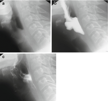 The Epiglottis: The Most Prominent Anatomical Structure in the Pharynx ...