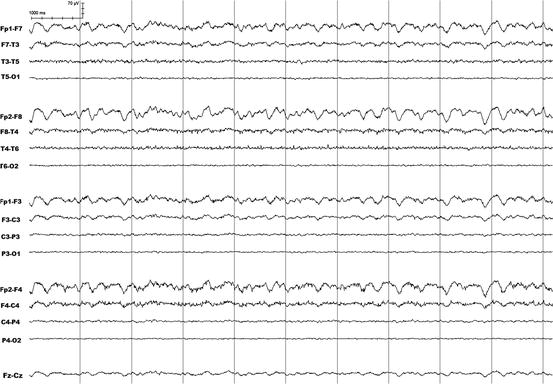 Artifacts Resembling Seizures | SpringerLink