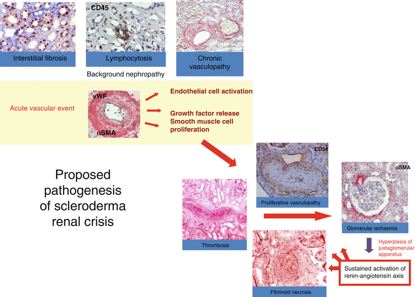 Scleroderma Renal Crisis | SpringerLink