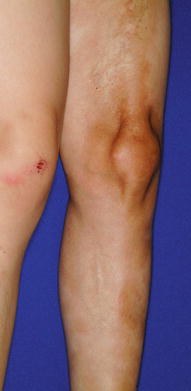 Juvenile Localized and Systemic Scleroderma | SpringerLink