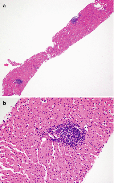 Portal Inflammation | SpringerLink