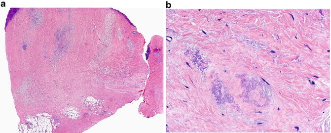 Anatomy of the Skin and Pathophysiology of Radiation Dermatitis ...