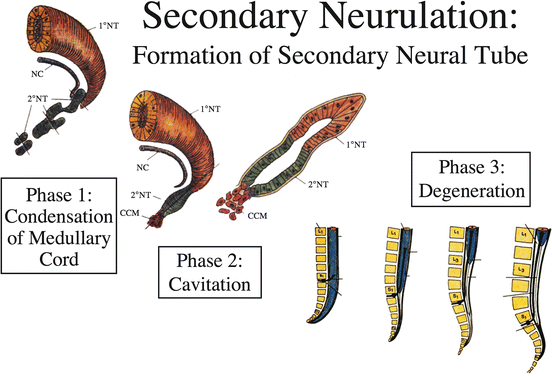 Secondary Neurulation