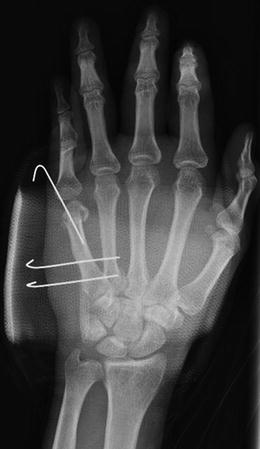 Finger Fractures and Dislocations | SpringerLink