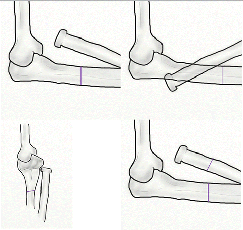 Monteggia Fracture | SpringerLink