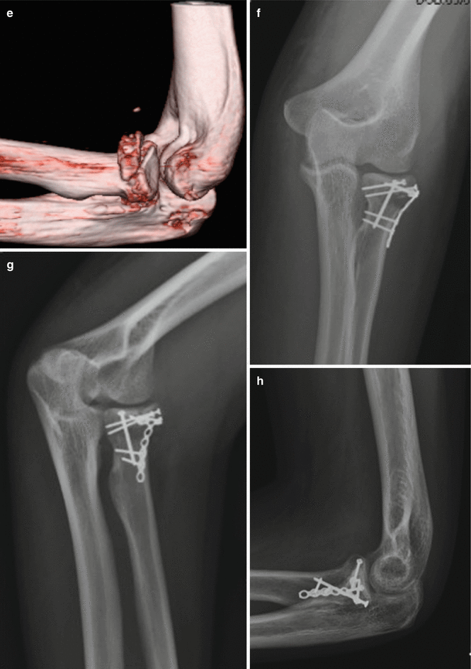 Reconstruction Techniques for Fractures of the Proximal Ulna and Radial ...