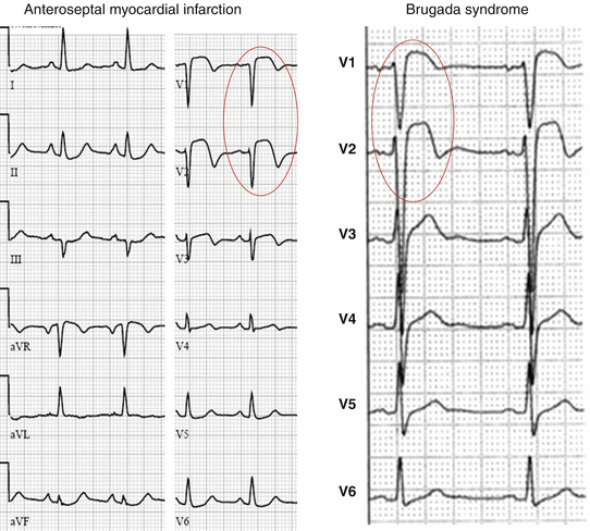 Update on the Differential Diagnosis and Treatment of Brugada Syndrome ...