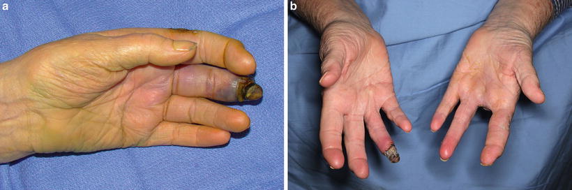 Upper Extremity Amputation | SpringerLink