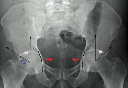 Pathophysiology of Femoroacetabular Impingement (FAI) | SpringerLink