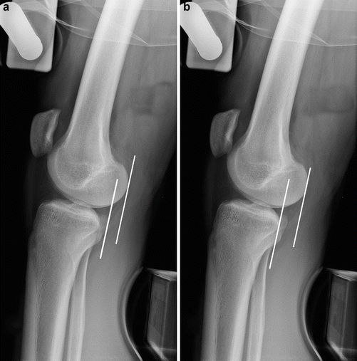 The Use of Stress X-Rays in the Evaluation of ACL Deficiency | SpringerLink