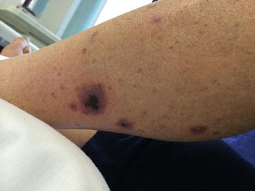 Calciphylaxis and Vitamin D | SpringerLink