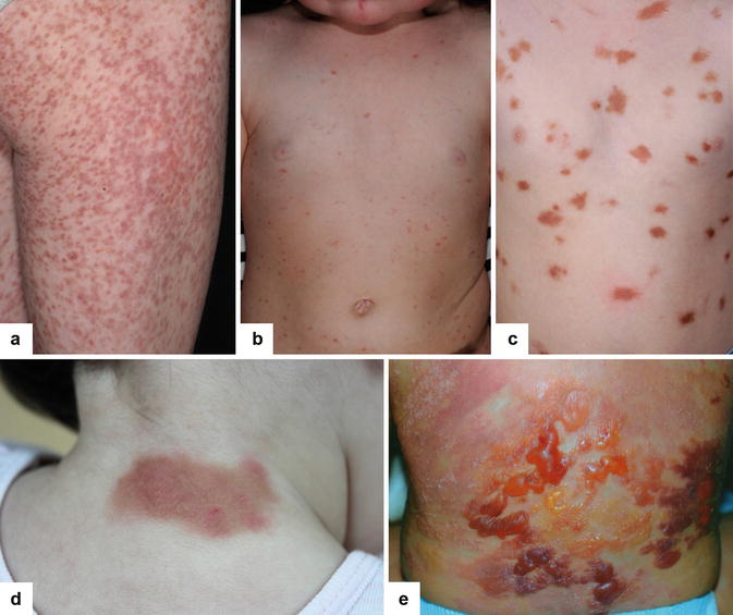 Mastocytosis | SpringerLink