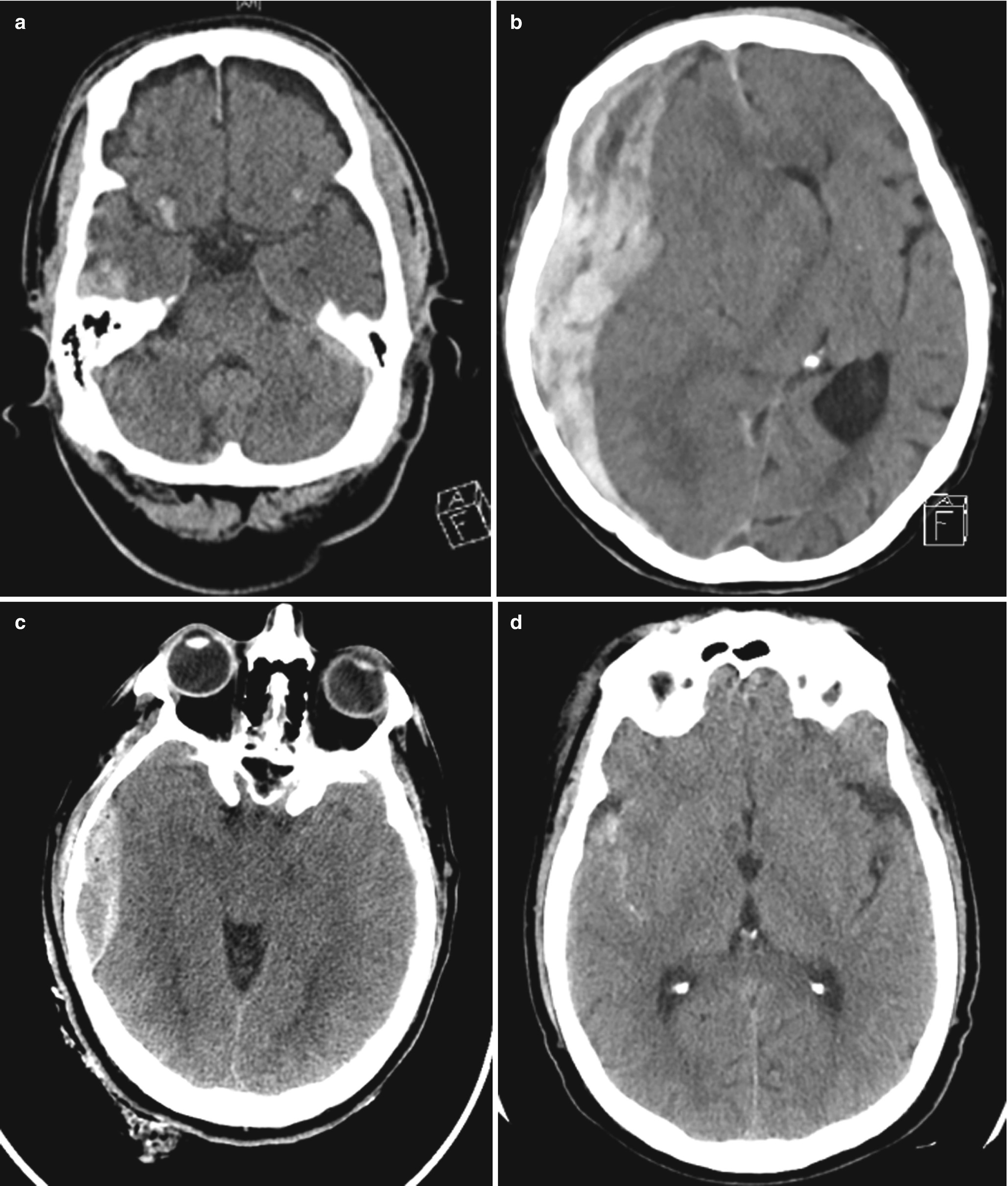 Traumatic Brain Injury | SpringerLink