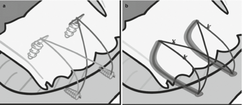 Suture Bridge and Transosseous Techniques | SpringerLink