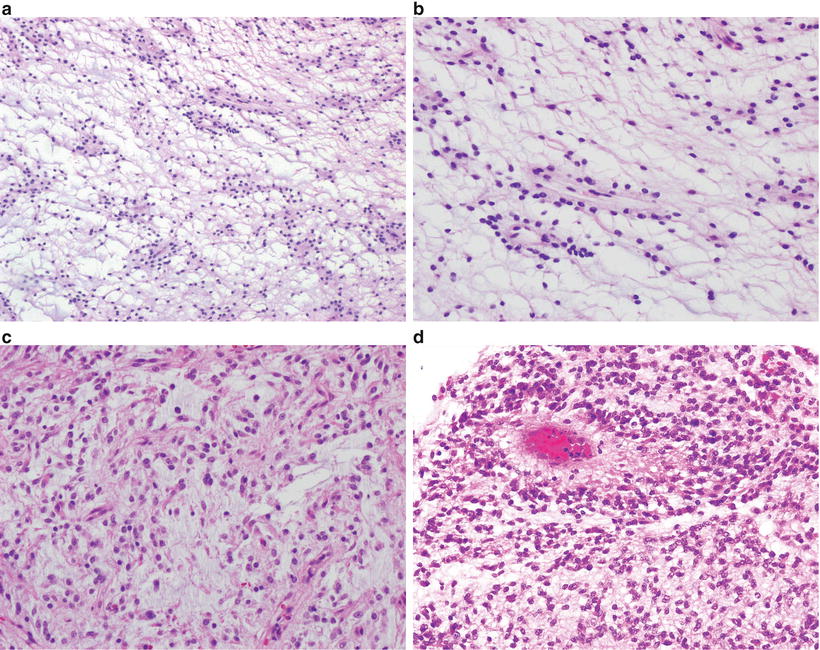 Pilocytic Astrocytoma and Pilomyxoid Astrocytoma | SpringerLink